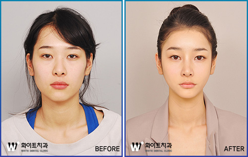 작고 입체적인 얼굴 원한다면 절대비율 양악수술 | bnt뉴스