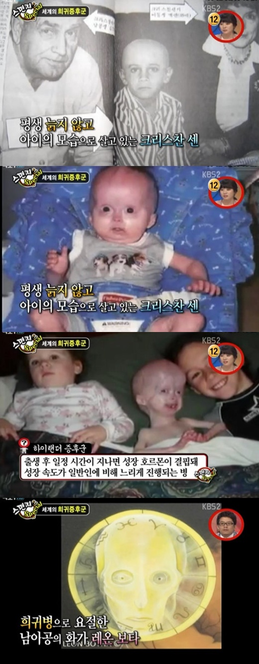 ‘스펀지 벤자민 버튼이 실존한다 늙지 않는 ‘하이랜더 증후군 Bnt뉴스