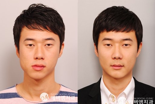 얼굴의 좌우 다른 안면비대칭, 양악수술로 균형 맞춰야 할 것 | bnt뉴스