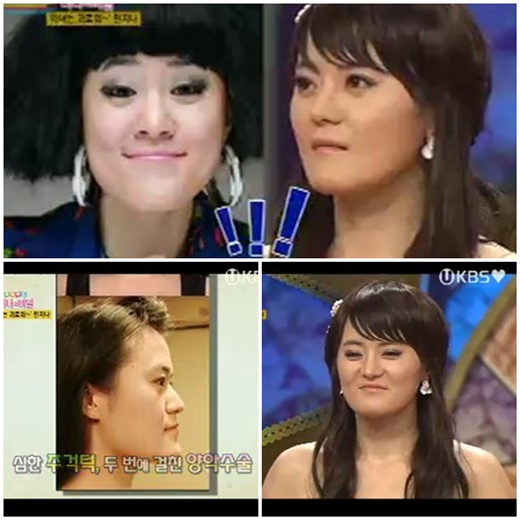 민지나 '전신성형비' 1억5천, 20kg 감량! 전→후, 어땠길래? | bnt뉴스